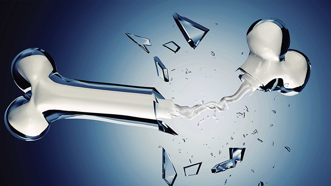 Blog | Çka Është Sëmundja e Brishtë e Kockave (Osteogenesis Imperfekta)?