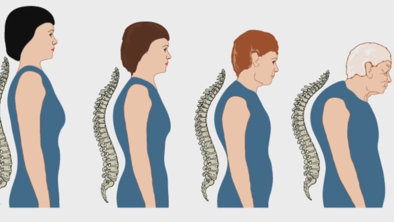 Kyphosis Treatment Medicabil